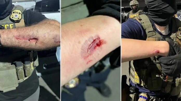 SEE IT: Bloody Photos Show ICE Officers With Bite Marks After Delaney ...